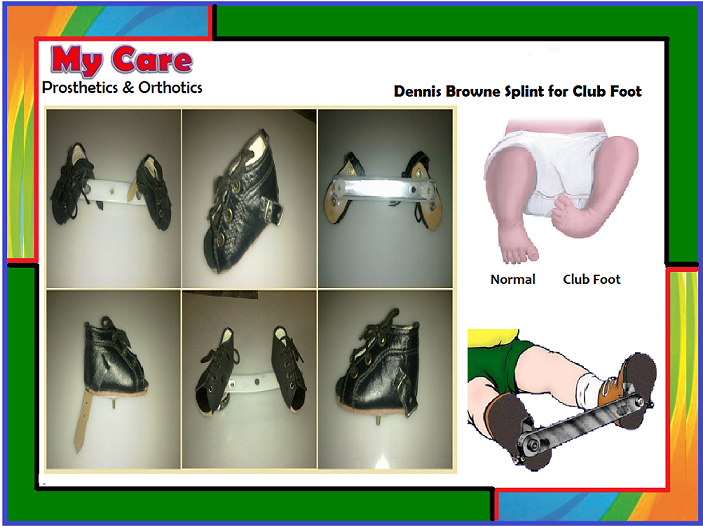 Club Foot CTEV Splint Or Dennis Browne Shoe/Splint - My Care ...